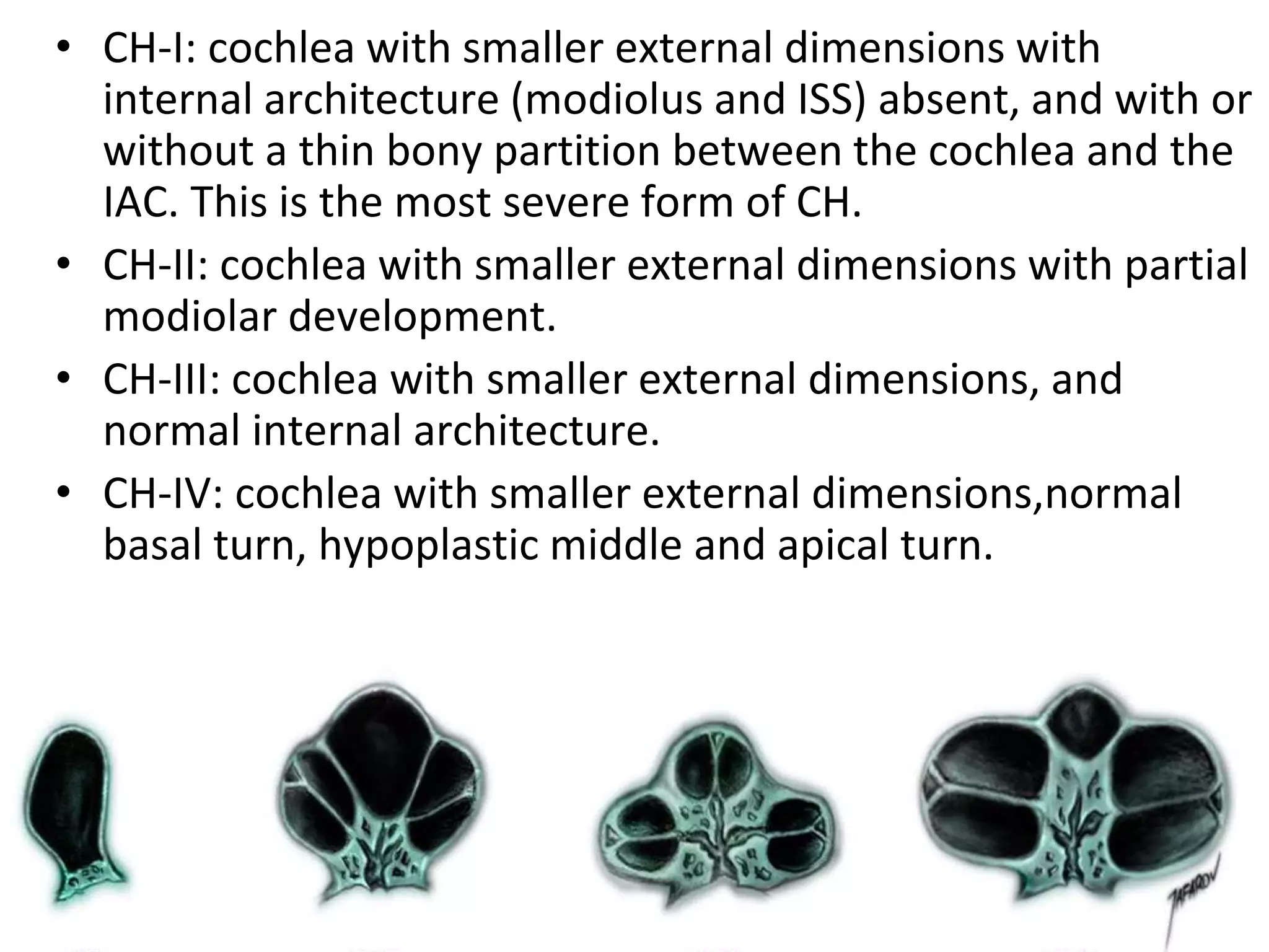 Congenital Malformations of Inner Ear.pptx