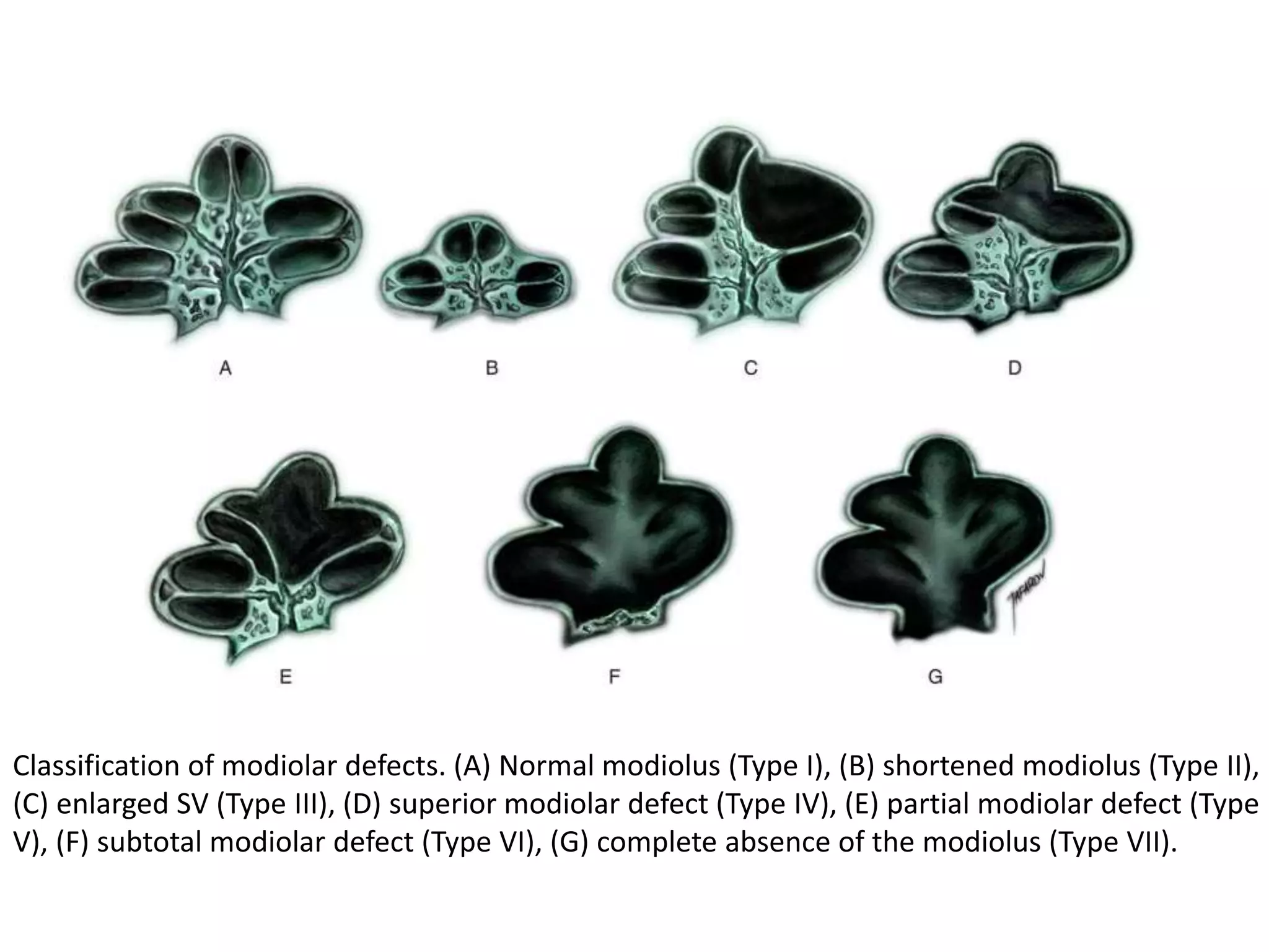 Congenital Malformations of Inner Ear.pptx