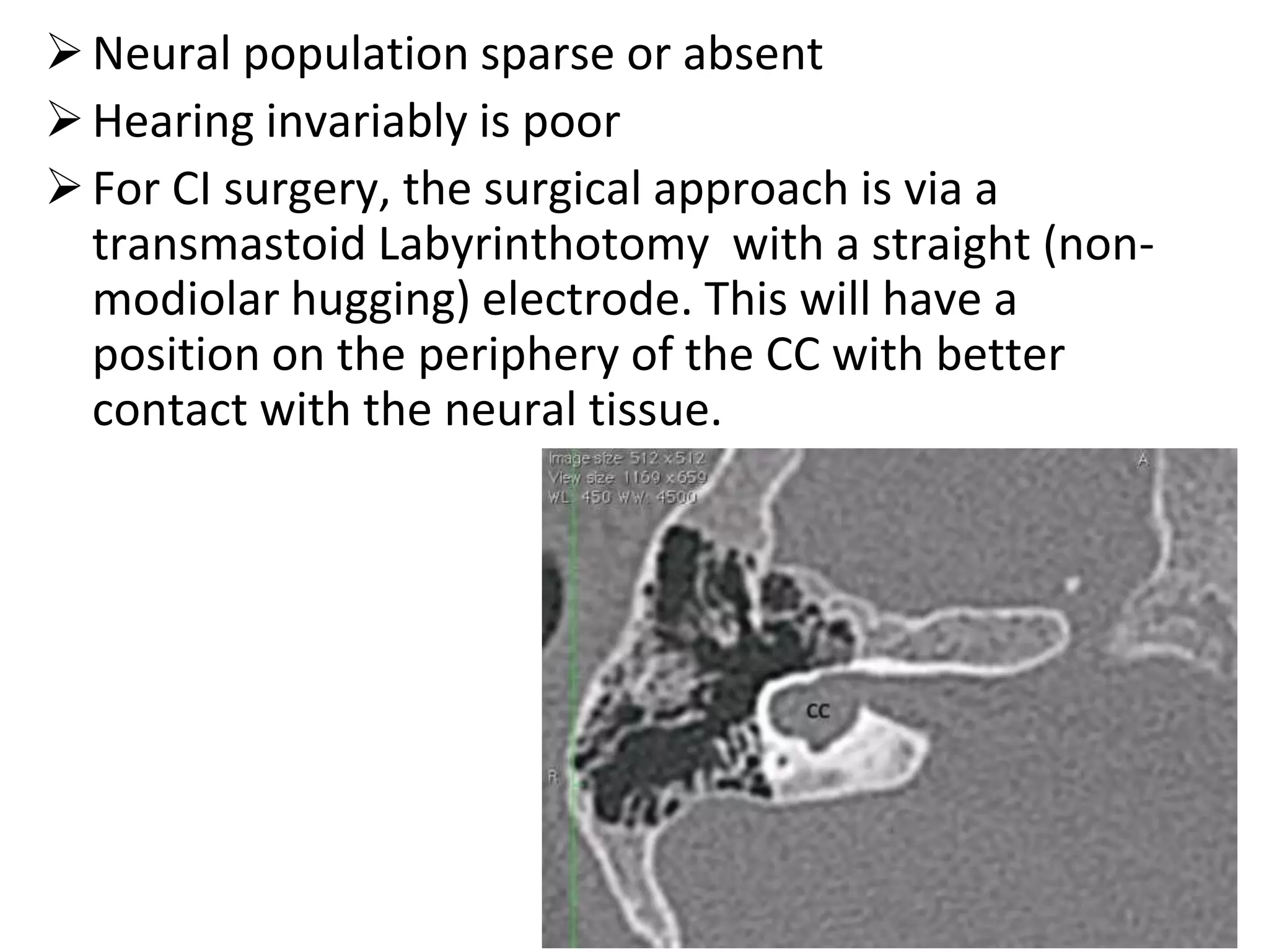 Congenital Malformations of Inner Ear.pptx