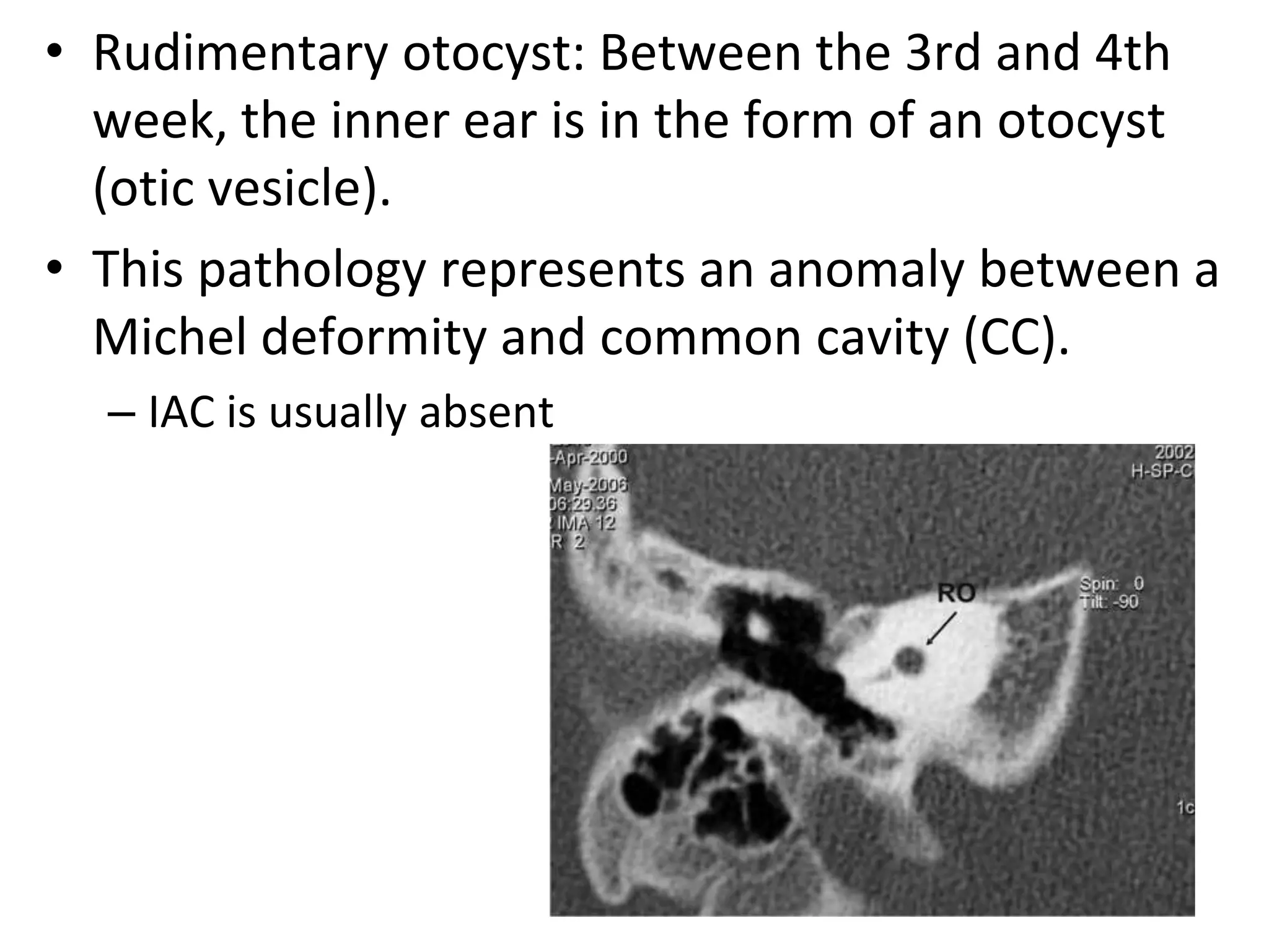 Congenital Malformations of Inner Ear.pptx