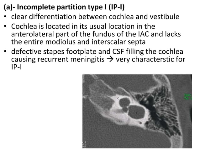 Congenital Malformations of Inner Ear.pptx | Ear, Nose and Throat ...