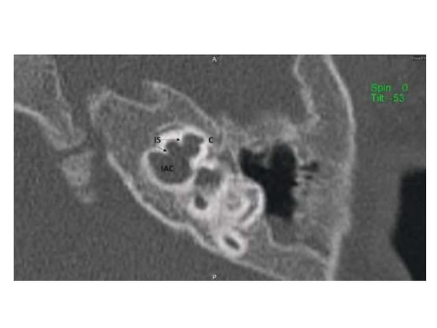 Congenital Malformations of Inner Ear.pptx | Ear, Nose and Throat ...