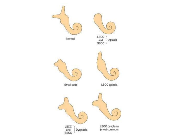 Congenital Malformations of Inner Ear.pptx | Ear, Nose and Throat ...