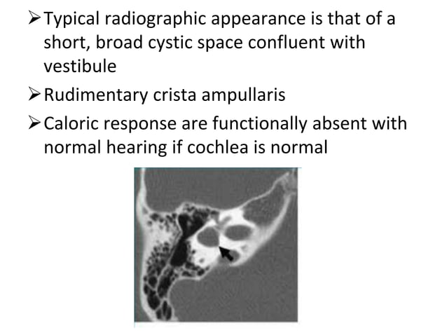 Congenital Malformations of Inner Ear.pptx | Ear, Nose and Throat ...