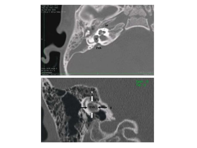 Congenital Malformations of Inner Ear.pptx | Ear, Nose and Throat ...