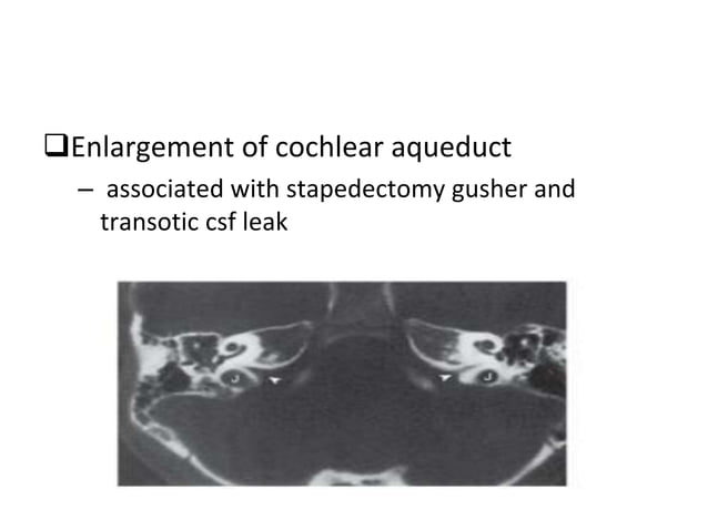 Congenital Malformations of Inner Ear.pptx | Ear, Nose and Throat ...