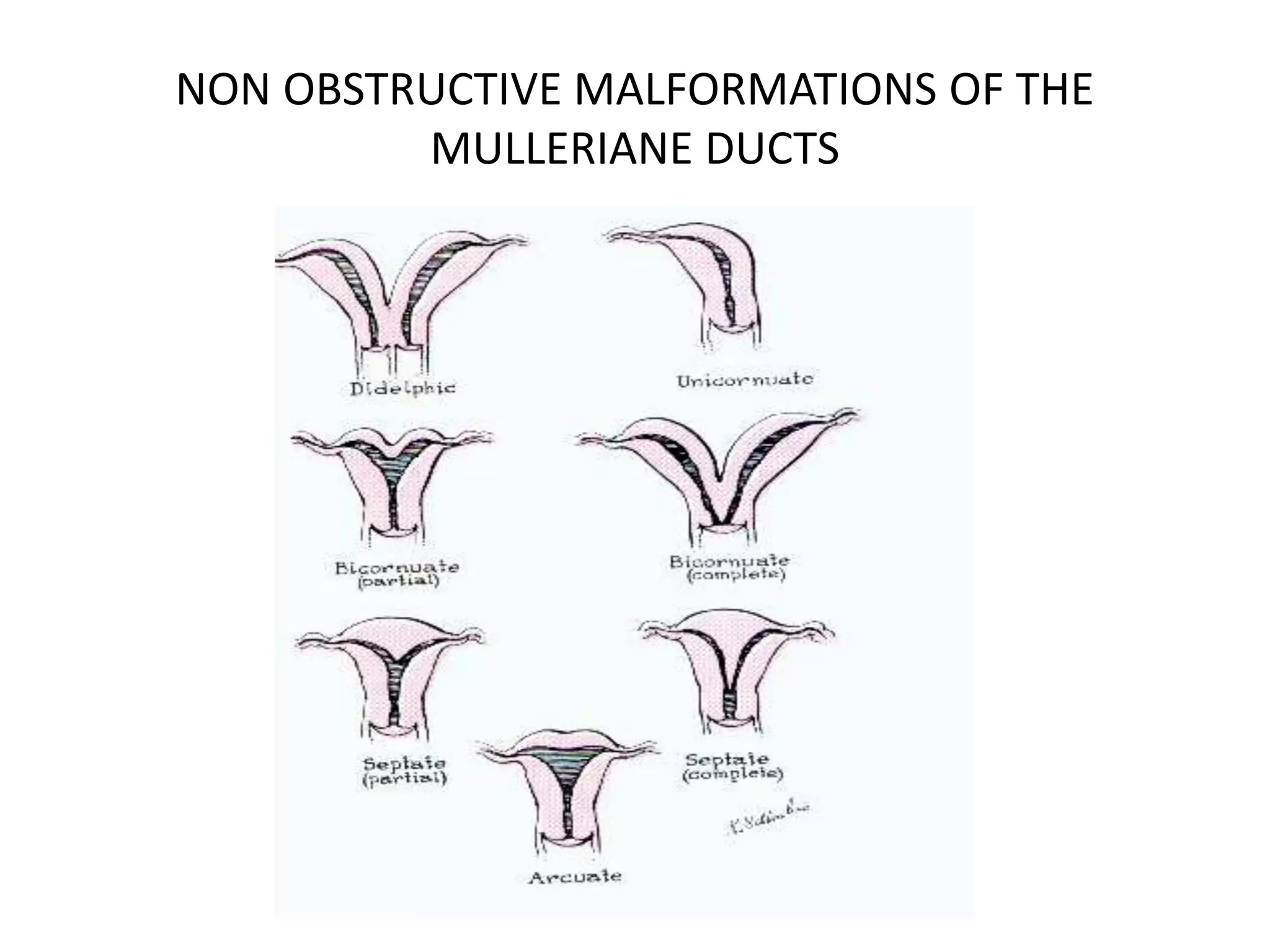Congenital Malformations of the Female genital Tract | PPT