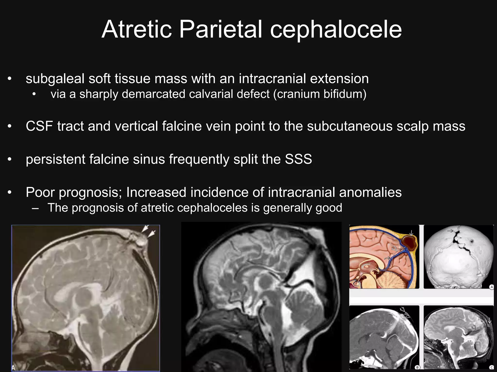 Congenital malformations of the brain abdul final | PDF