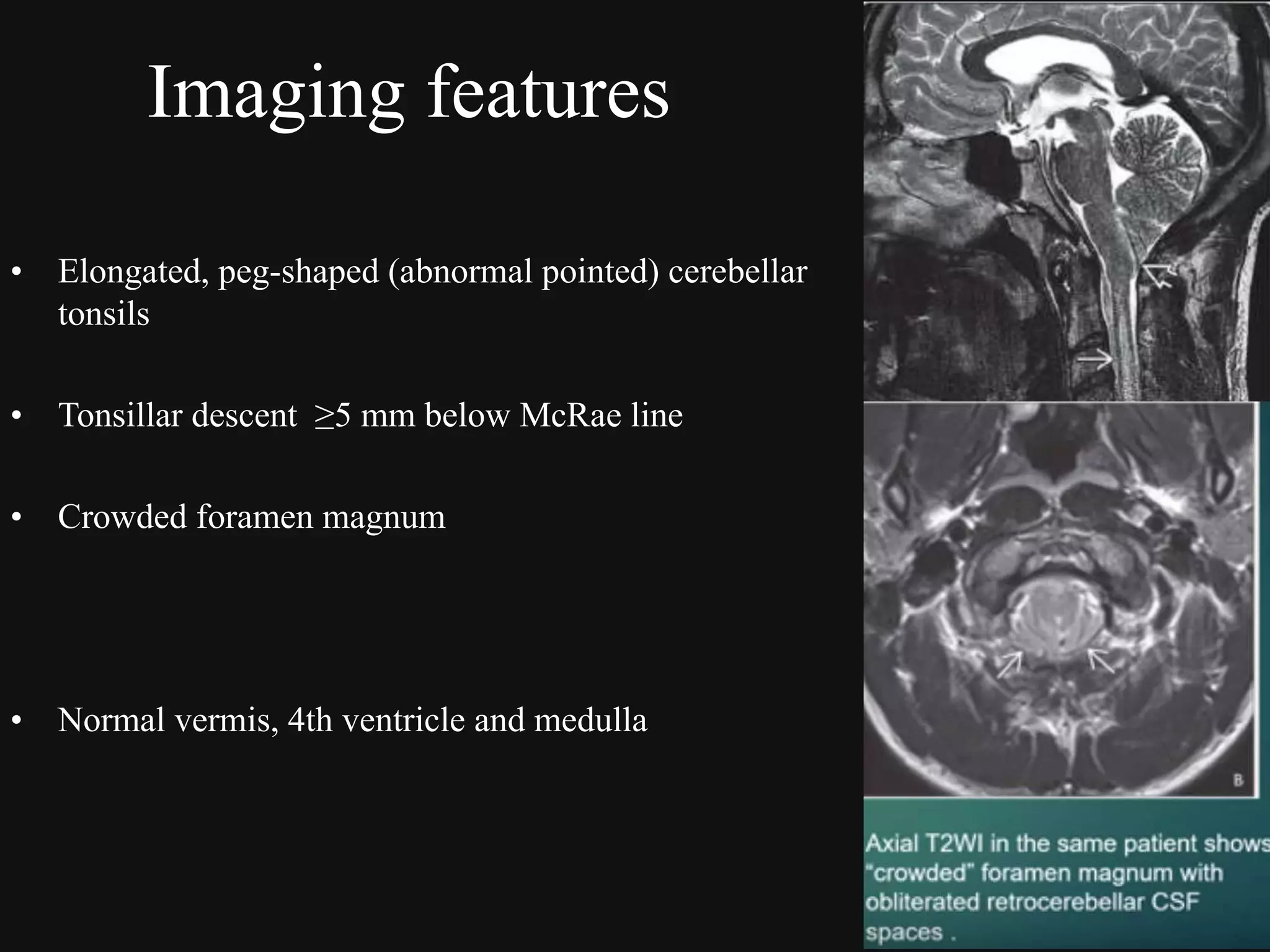 Congenital malformations of the brain abdul final | PDF