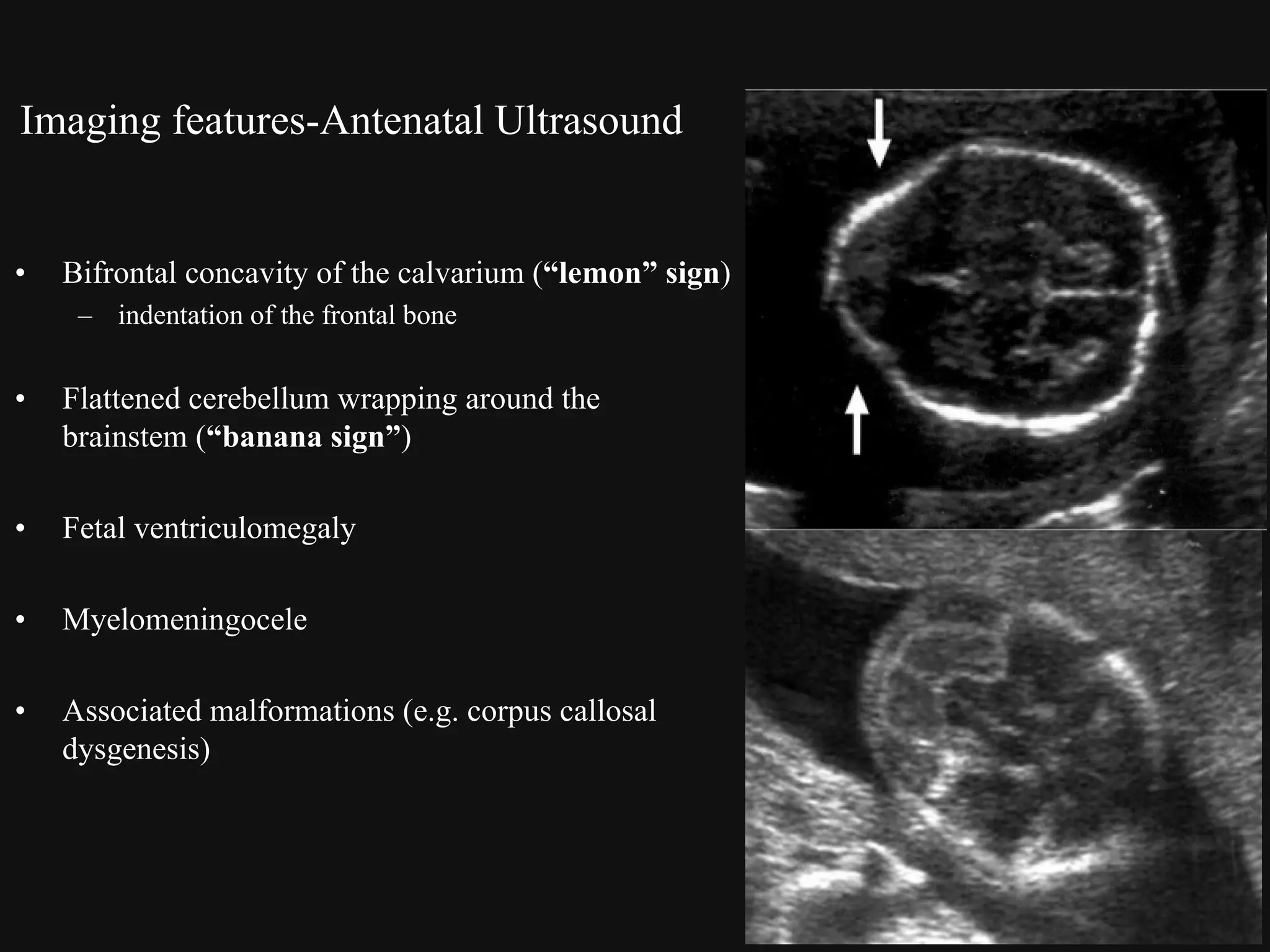 Congenital malformations of the brain abdul final | PDF