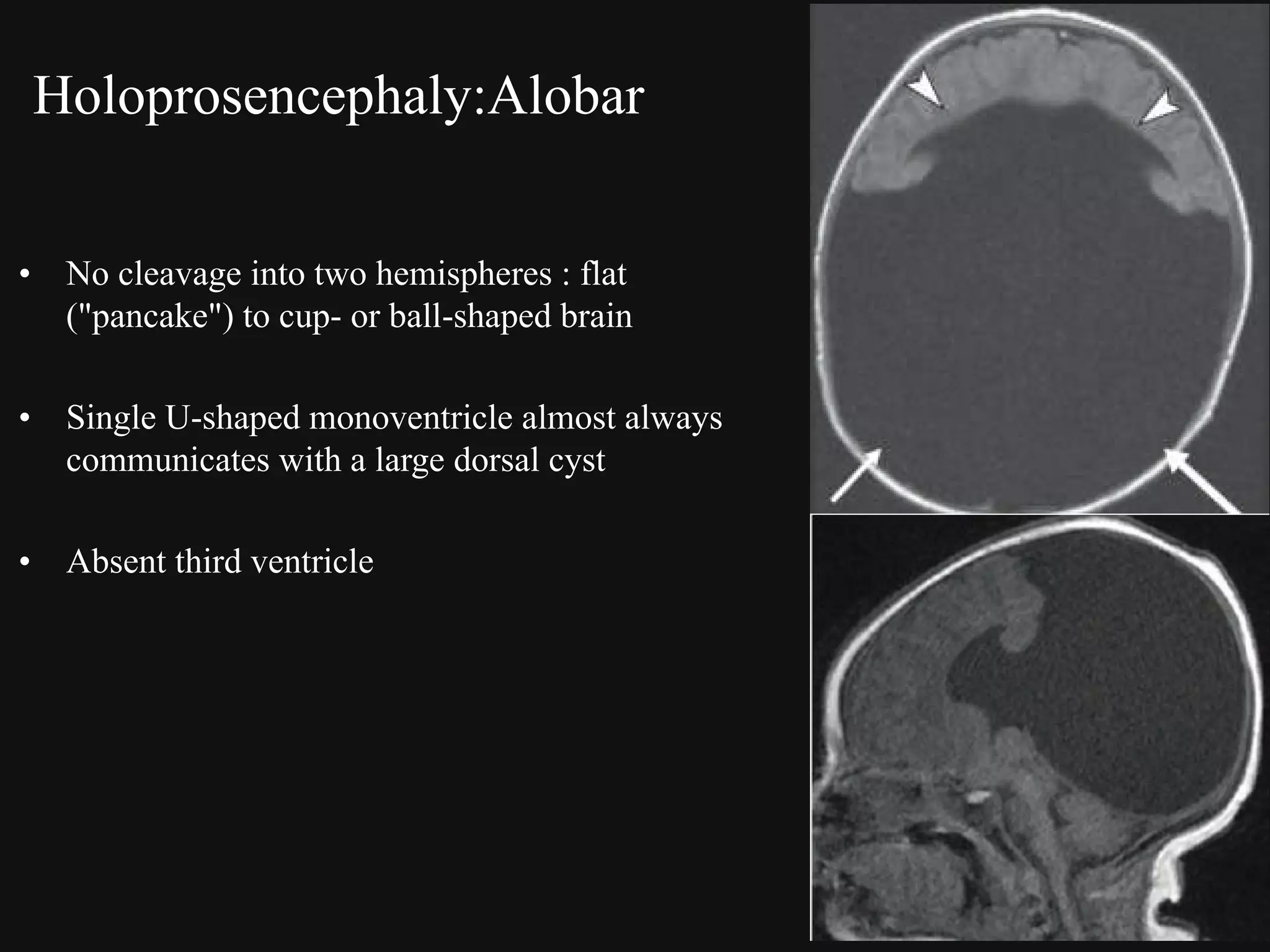 Congenital malformations of the brain abdul final | PDF