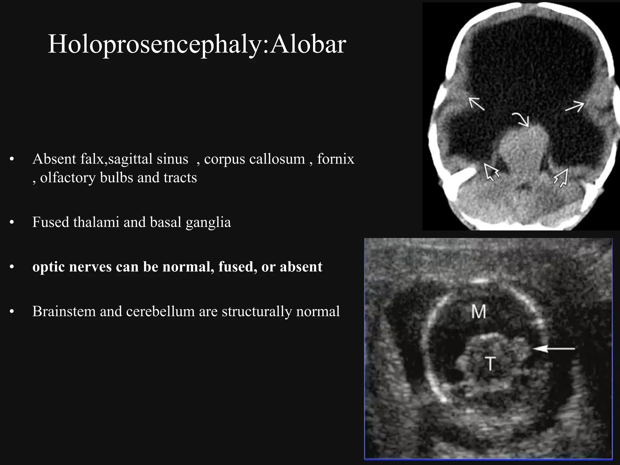 Congenital malformations of the brain abdul final | PDF