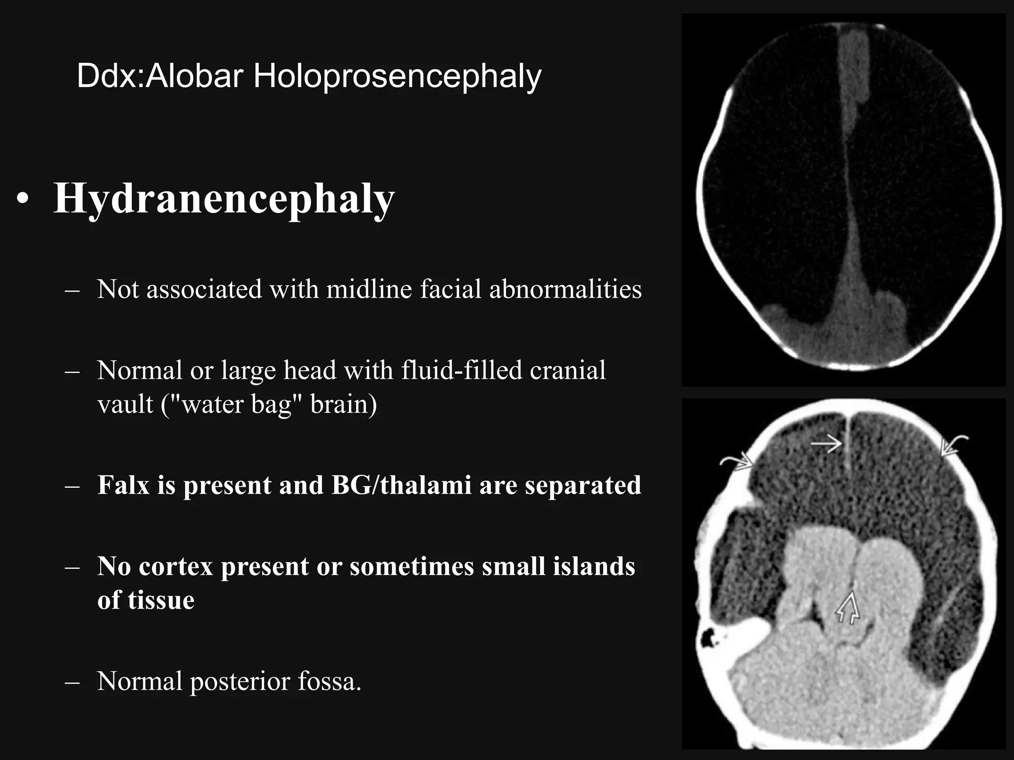 Congenital malformations of the brain abdul final | PDF