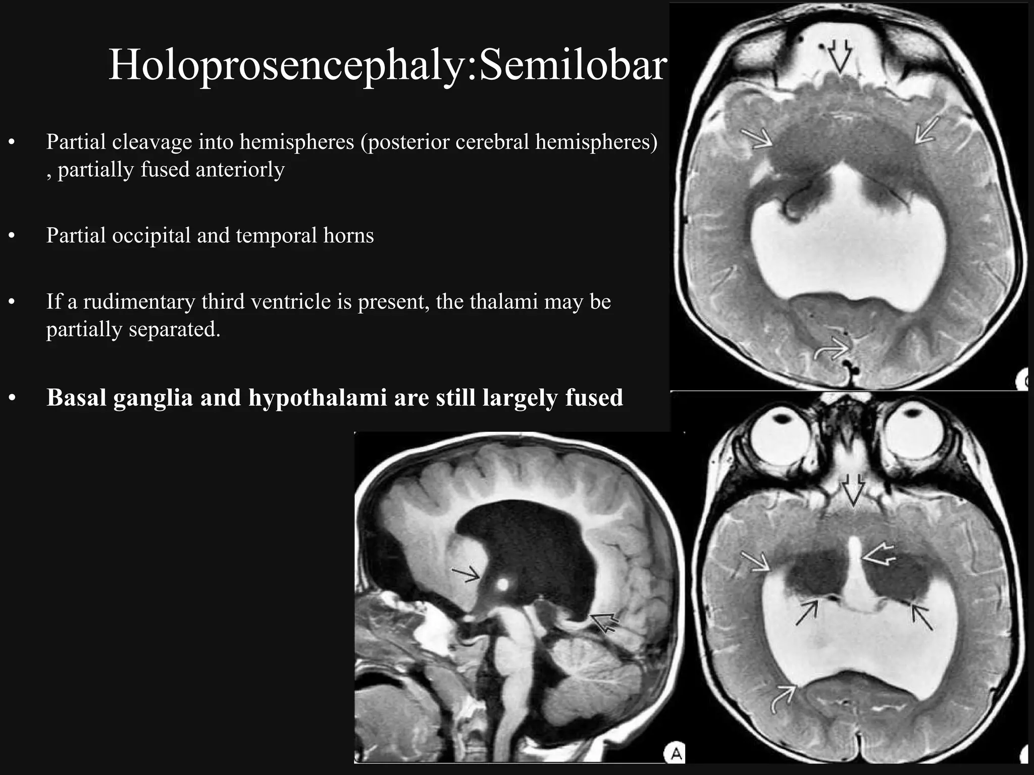 Congenital malformations of the brain abdul final | PDF