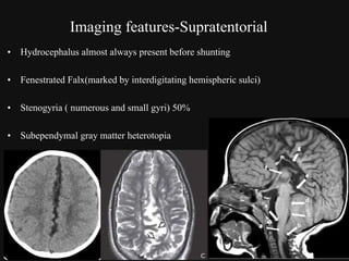 Congenital malformations of the brain abdul final | PDF