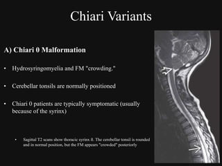 Congenital malformations of the brain abdul final | PDF