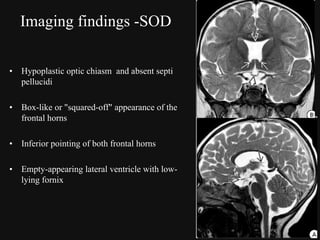 Congenital malformations of the brain abdul final | PDF