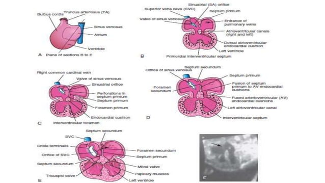 Congenital malformation the the heart | PPTX | Heart and Cardiovascular ...