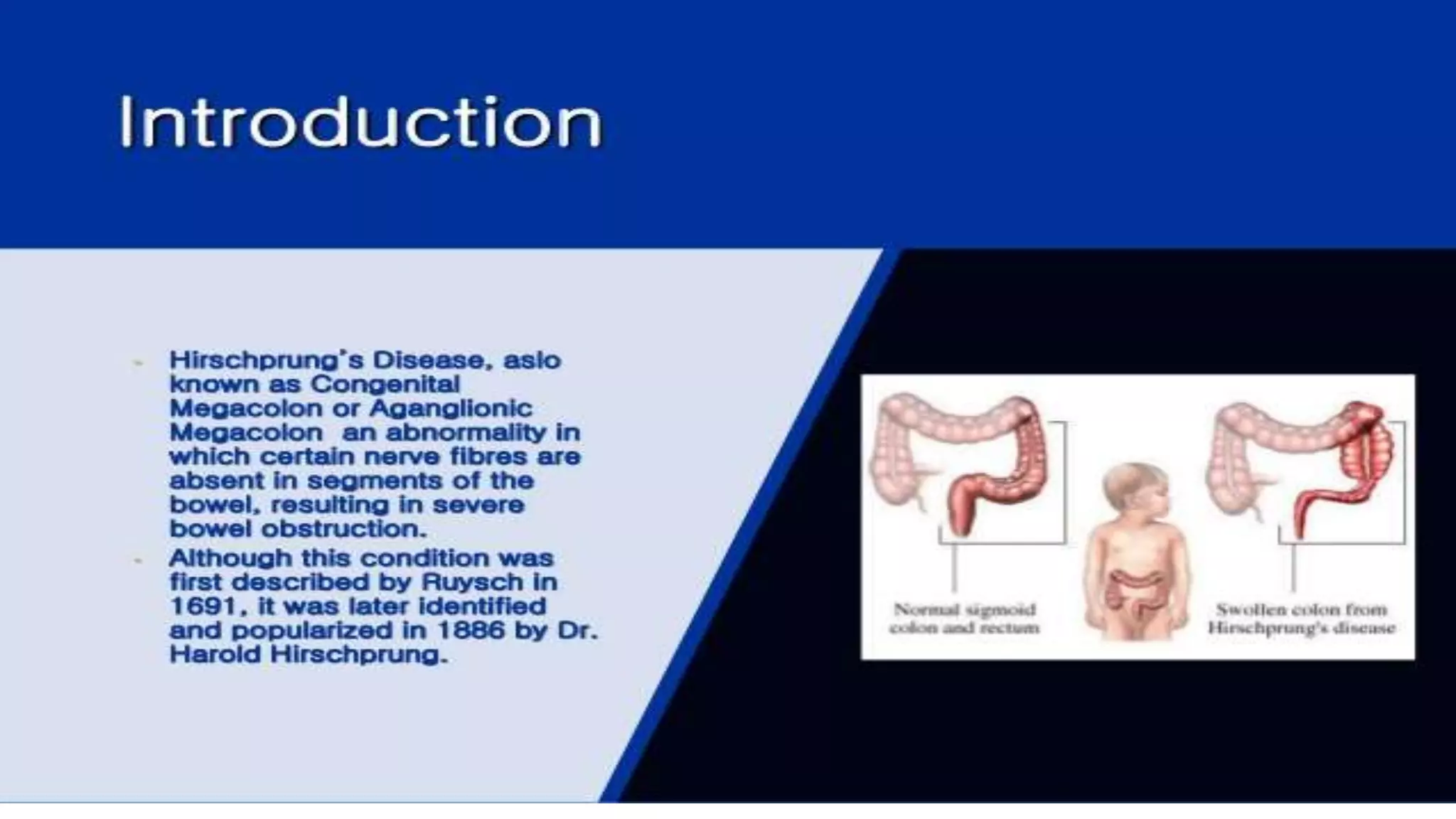 Congenital megacolon PPT | PPTX