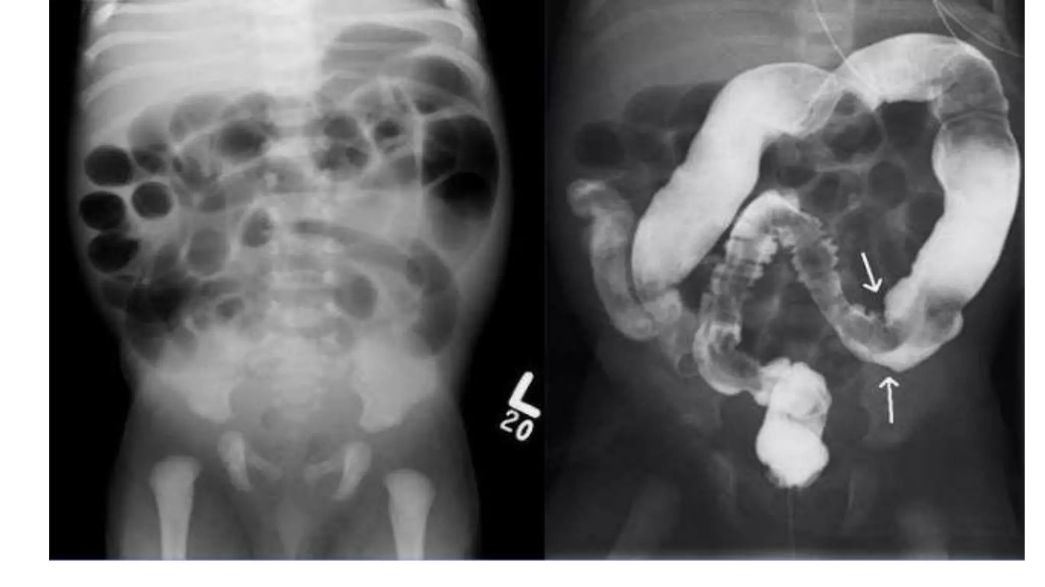 Congenital megacolon PPT | PPTX