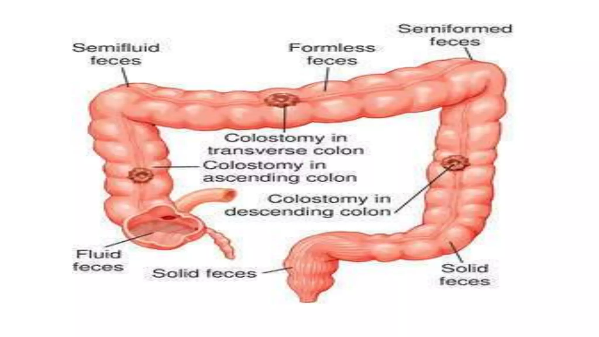 Congenital megacolon PPT | PPTX