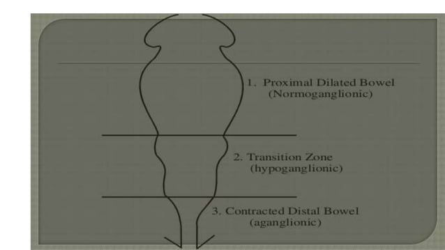 Congenital megacolon PPT | PPTX | Digestive Disorders | Diseases and ...
