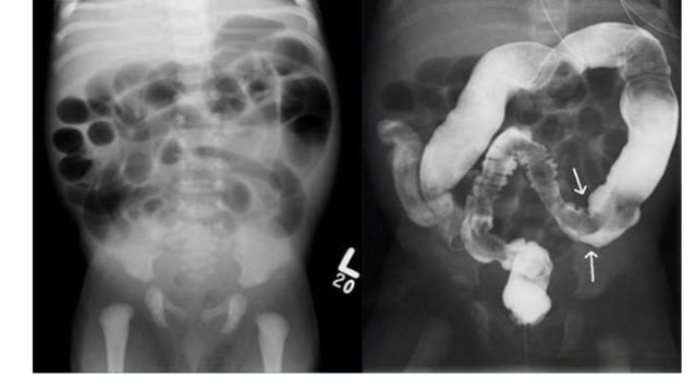 Congenital megacolon PPT | PPTX | Digestive Disorders | Diseases and ...