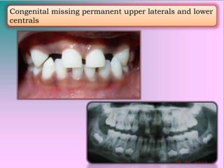 Congenital missing lateral incisors | PPTX