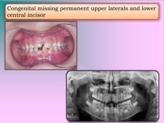 Congenital missing lateral incisors | PPTX