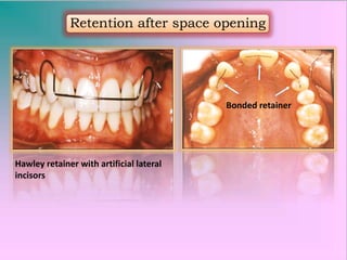 Congenital missing lateral incisors | PPT