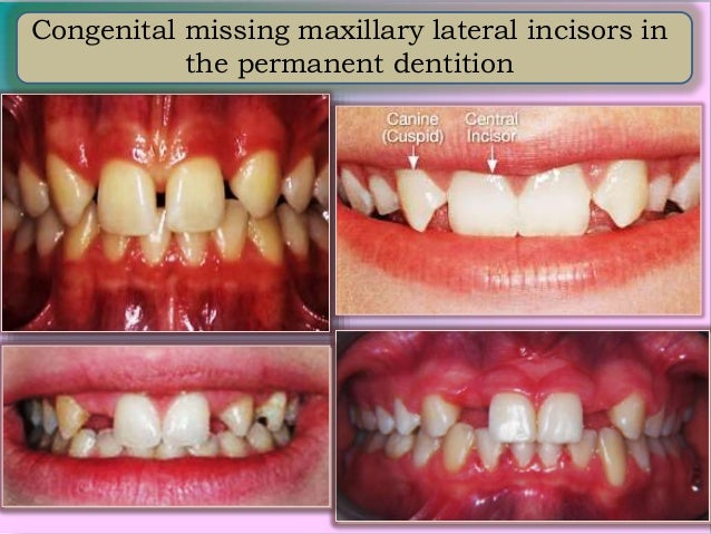 Congenital missing lateral incisors