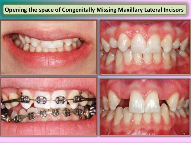Congenital missing lateral incisors