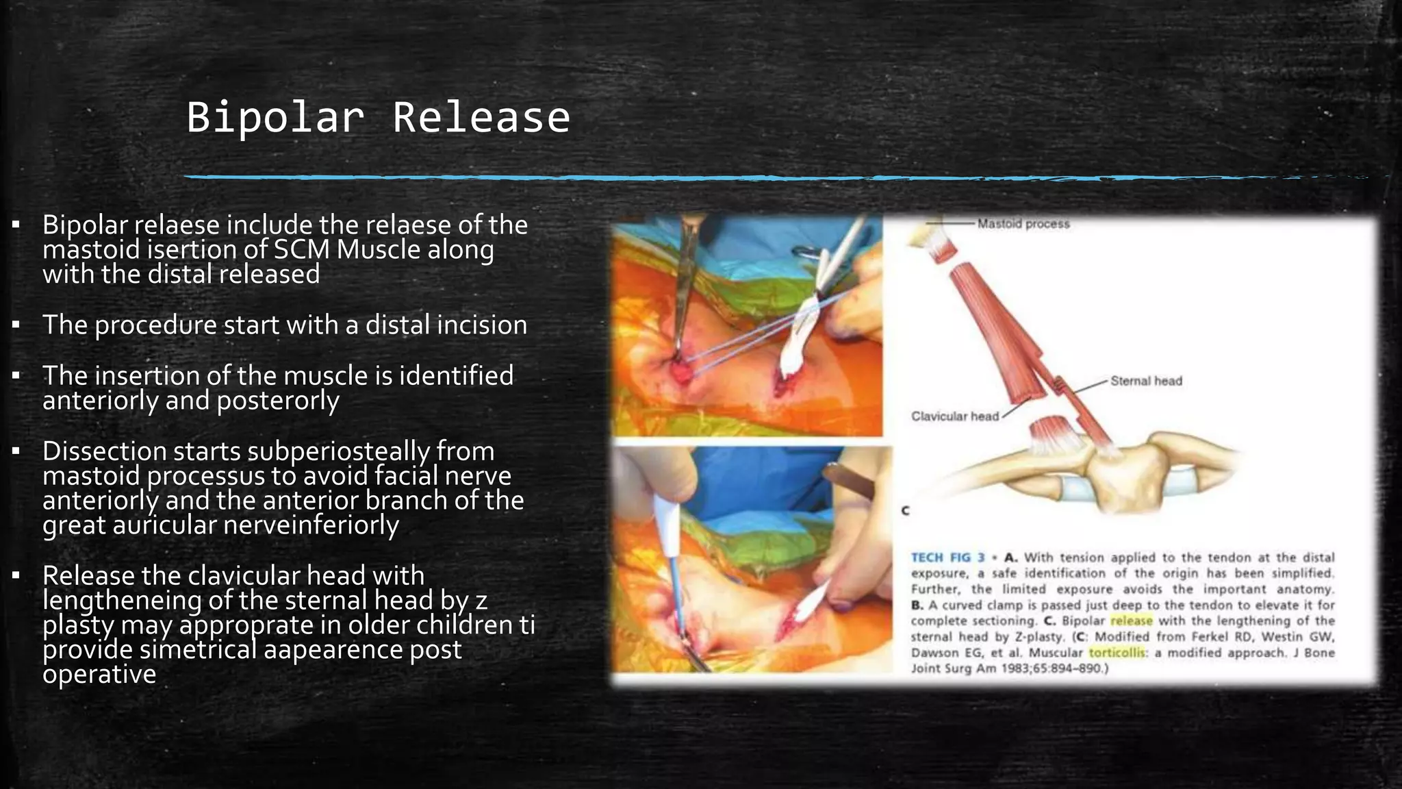 Congenital muscular torticollis | PPTX