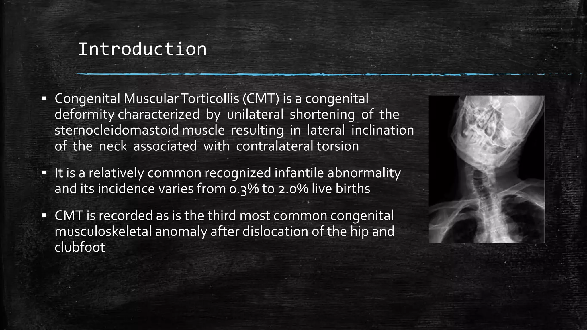 Congenital muscular torticollis | PPTX