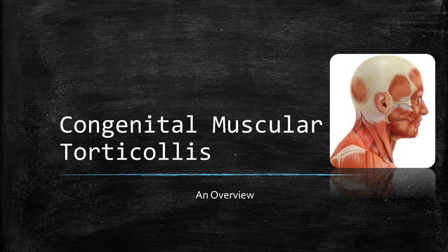 Congenital muscular torticollis | PPTX | Pregnancy | Reproductive Health
