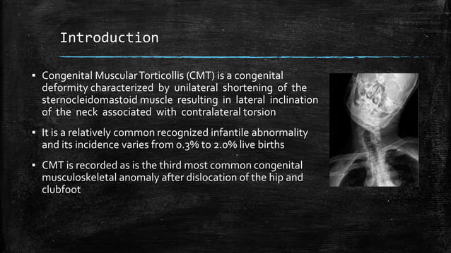 Congenital muscular torticollis | PPTX | Pregnancy | Reproductive Health