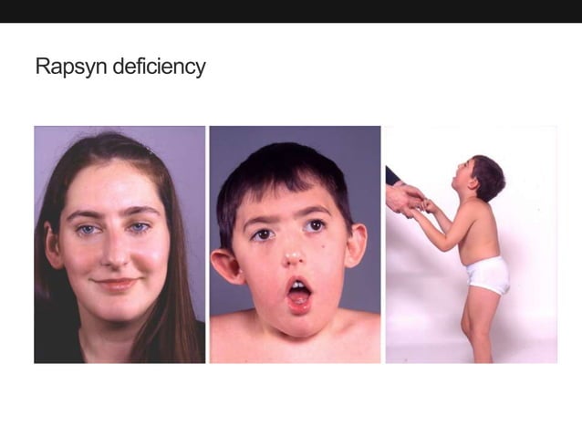 Congenital myasthenic syndromes_24th jan'20.pptx | Brain and Nervous ...