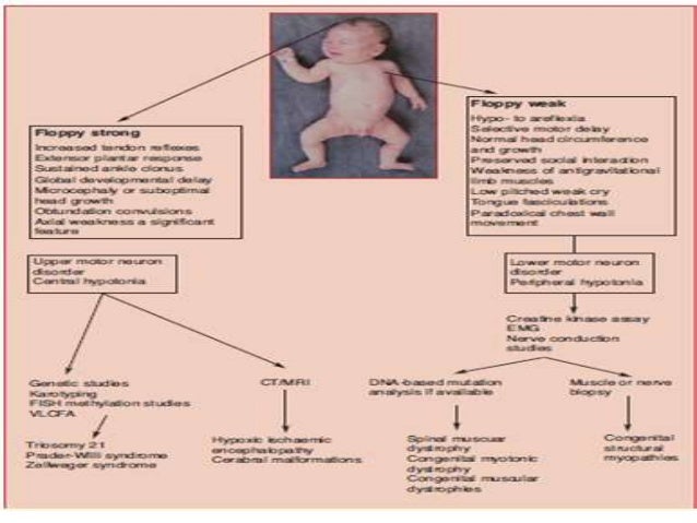 Congenital myopathy