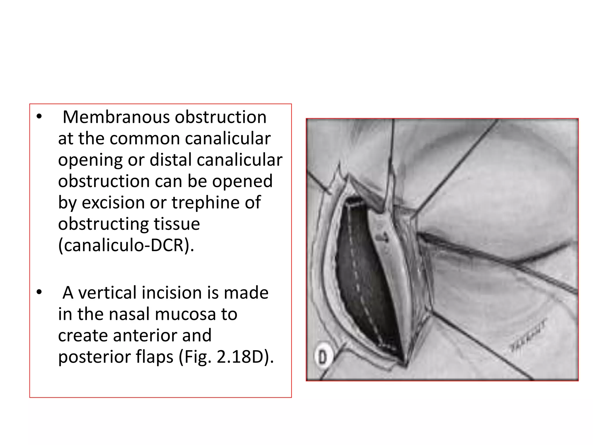 Congenital nasolacrimal duct obstruction | PPTX