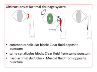 Congenital nasolacrimal duct obstruction | PPTX