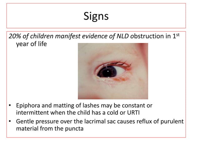 Congenital Nasolacrimal Duct Obstruction Ppt