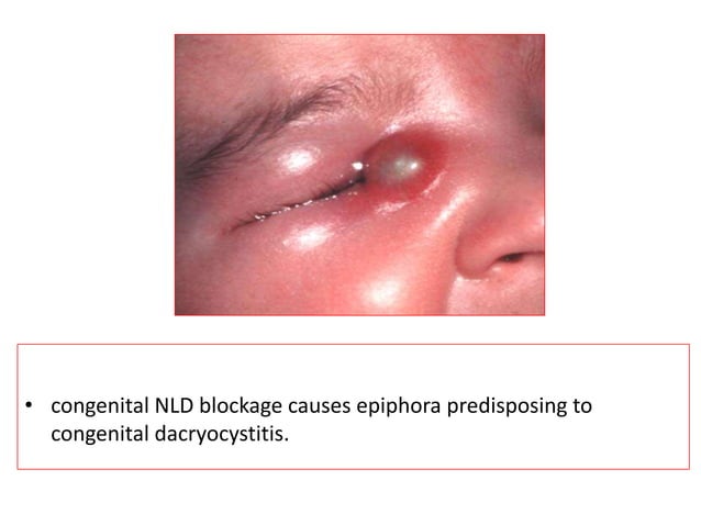 Congenital Nasolacrimal Duct Obstruction Ppt