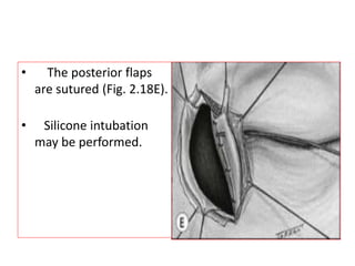 Congenital nasolacrimal duct obstruction | PPTX