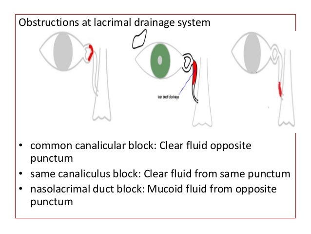 Congenital nasolacrimal duct obstruction