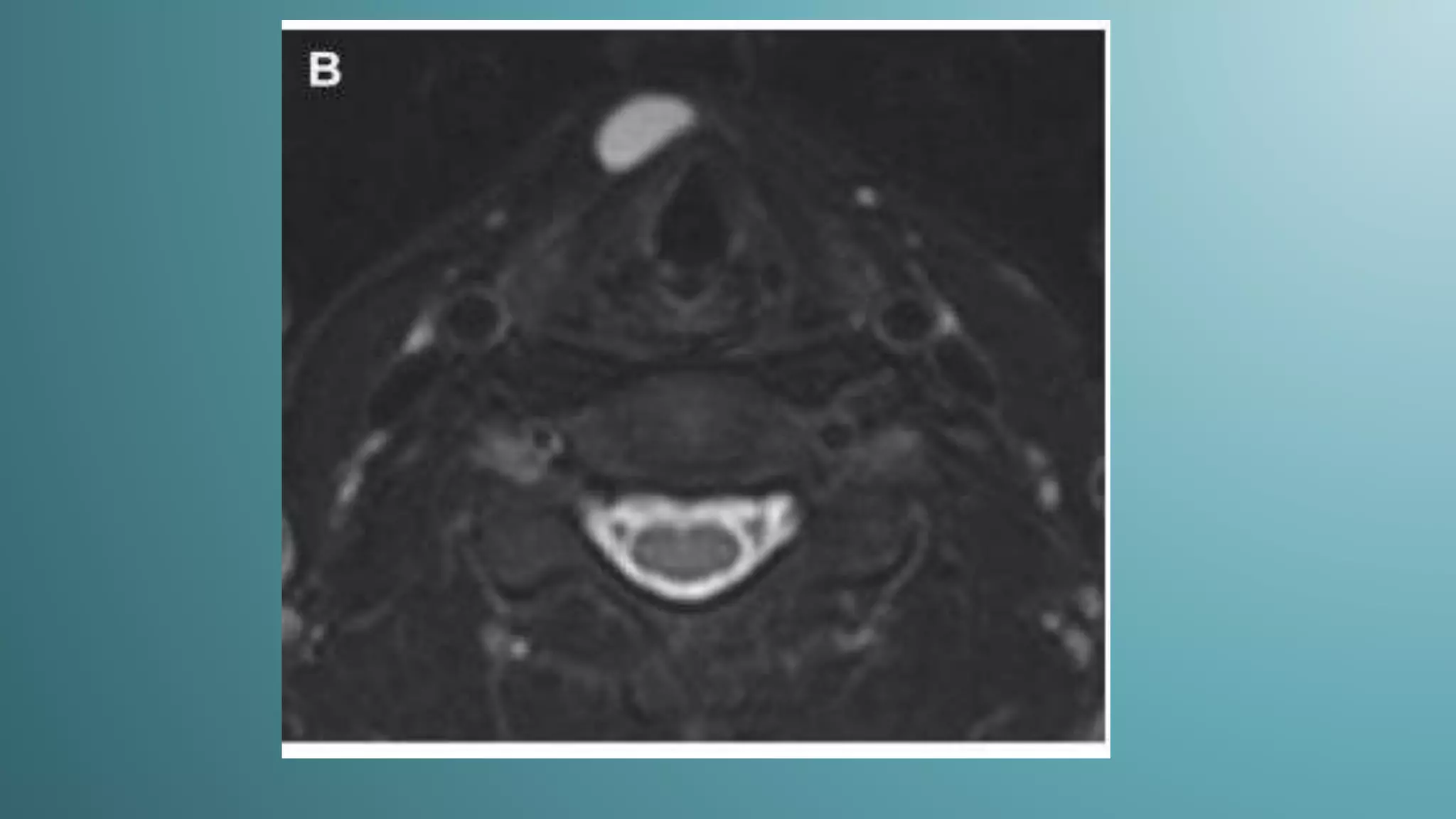 Congenital neck mass radiology pk final | PPTX