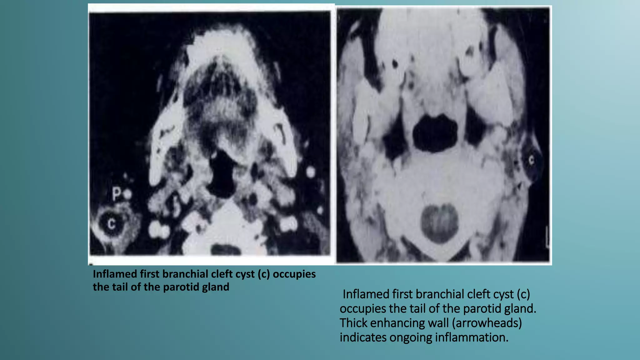 Congenital neck mass radiology pk final | PPTX
