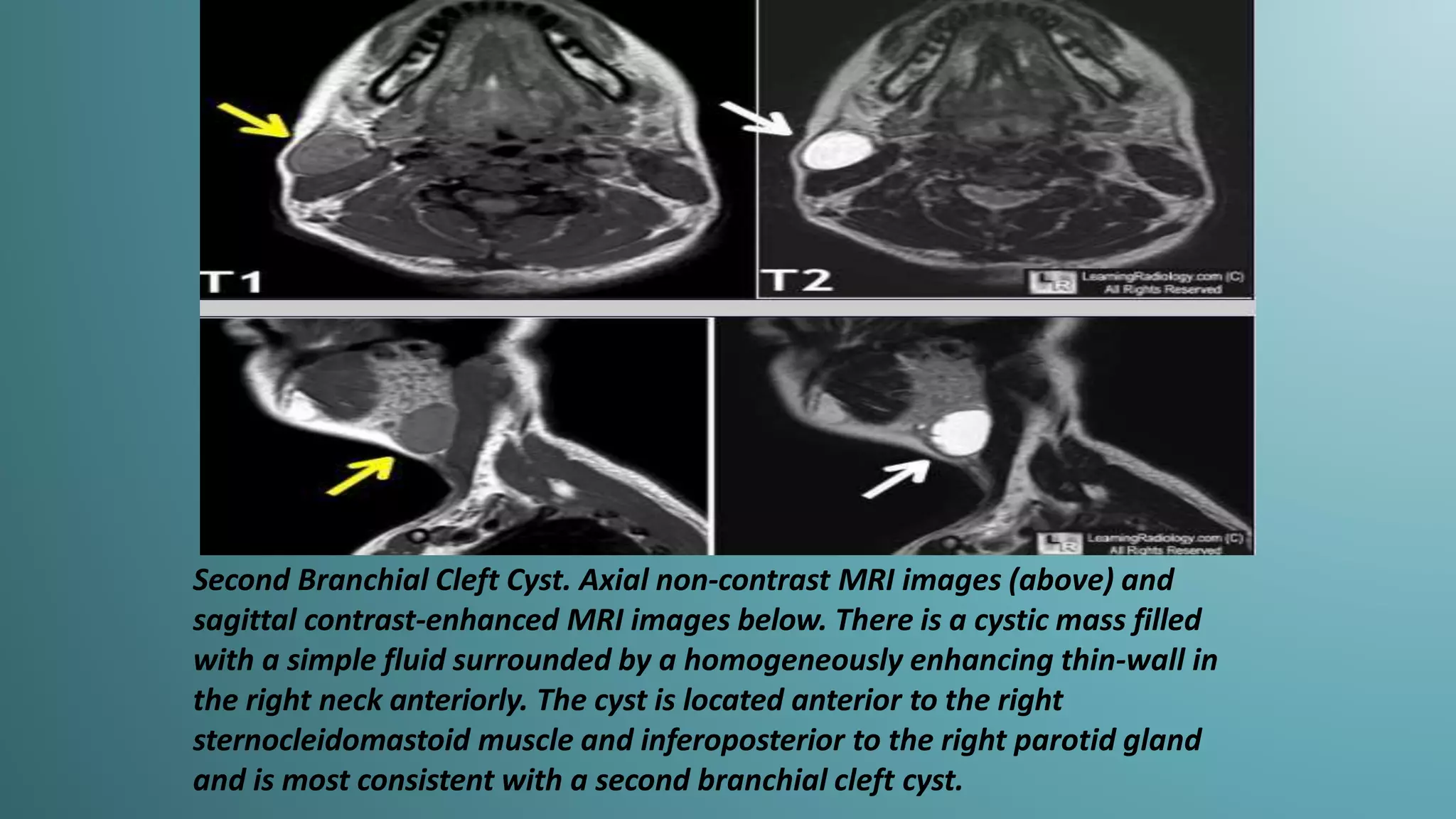 Congenital neck mass radiology pk final | PPTX