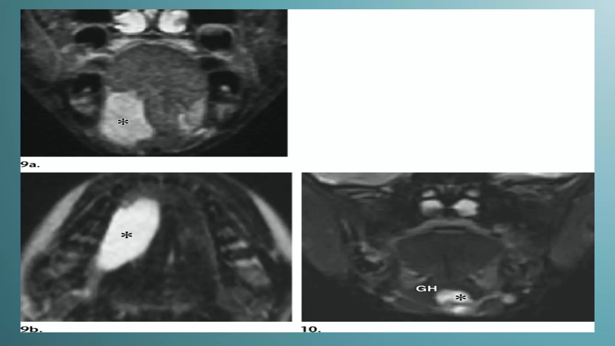 Congenital neck mass radiology pk final | PPTX