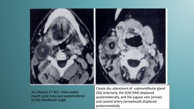 Congenital neck mass radiology pk final | PPTX