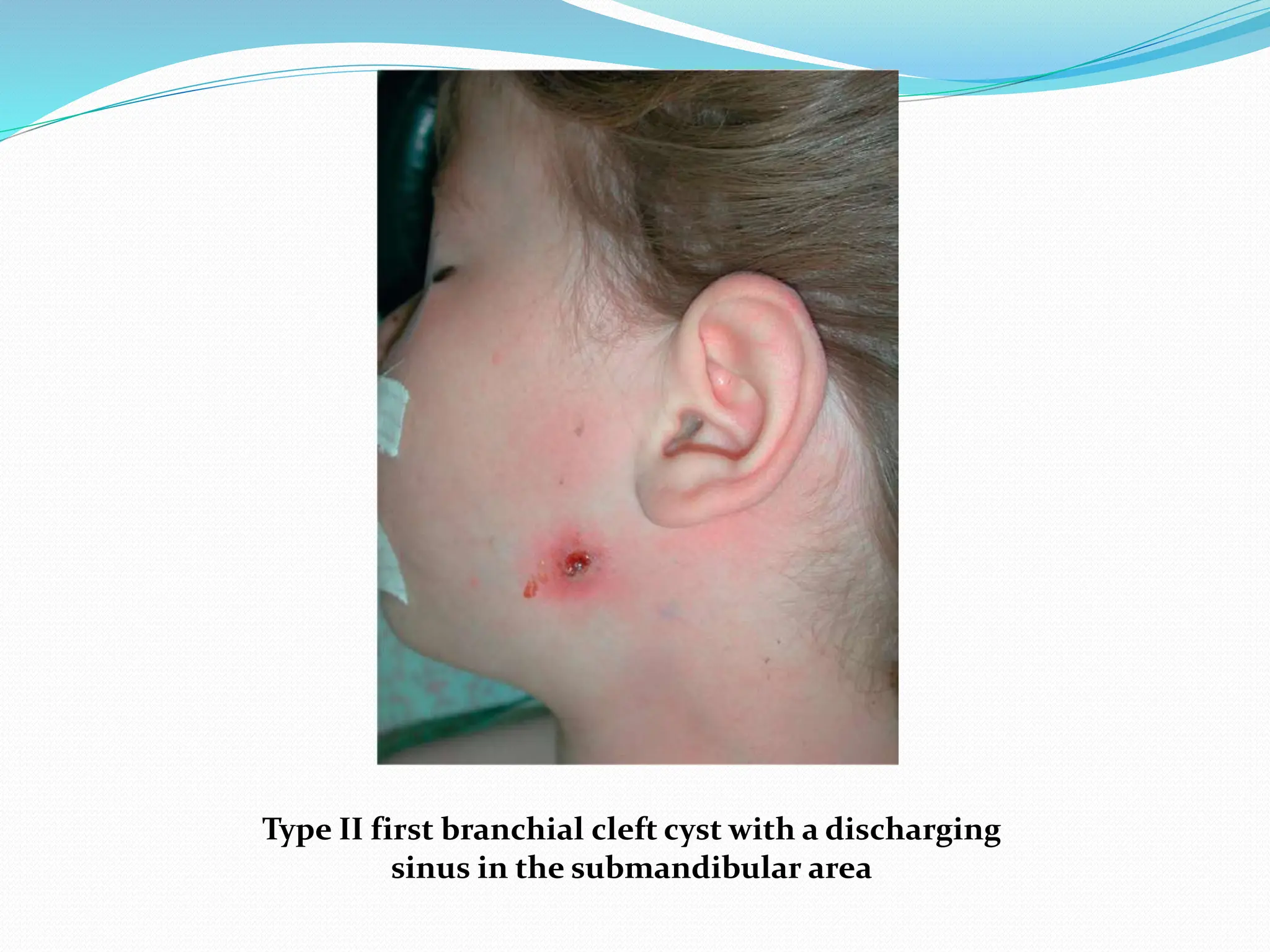 Congenital Sinuses of The Neck and its Etiology | PPTX